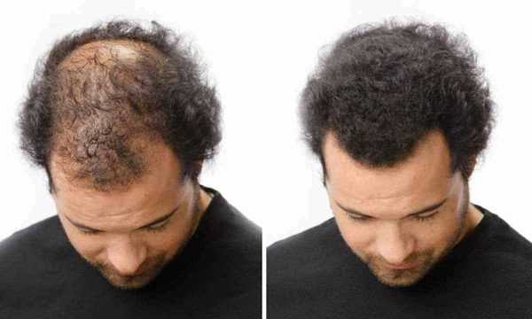 Balding? 8 Best Men's Hairstyles For Thinning Hair - Too Manly